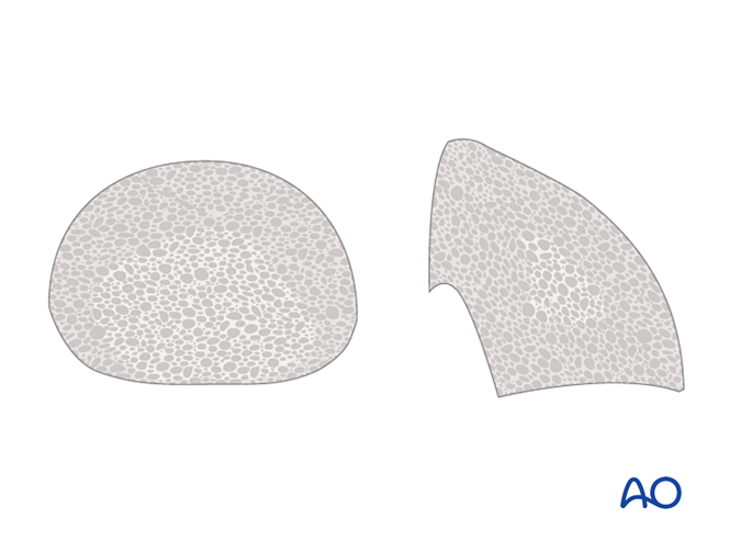 Revision of cup to multihole pressfit cup with augments for ...