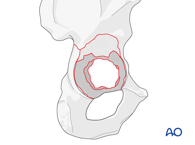 Revision of cup to antiprotrusio cage for Pelvic discontinuity