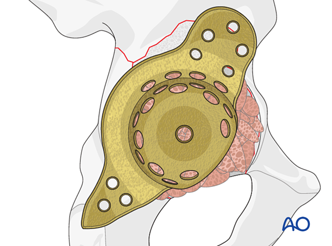 Revision of cup to antiprotrusio cage for Spontaneous acetabular fracture