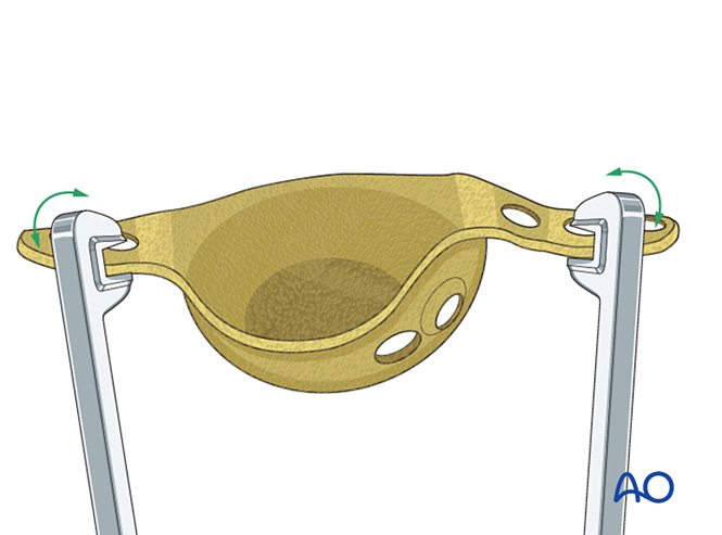 Revision of cup to antiprotrusio cage for Intraoperative fracture ...