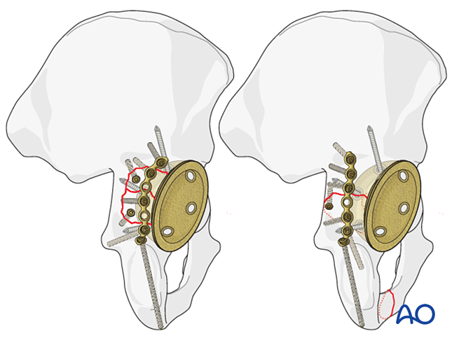 ORIF of posterior moiety fractures for Intraoperative fracture during ...