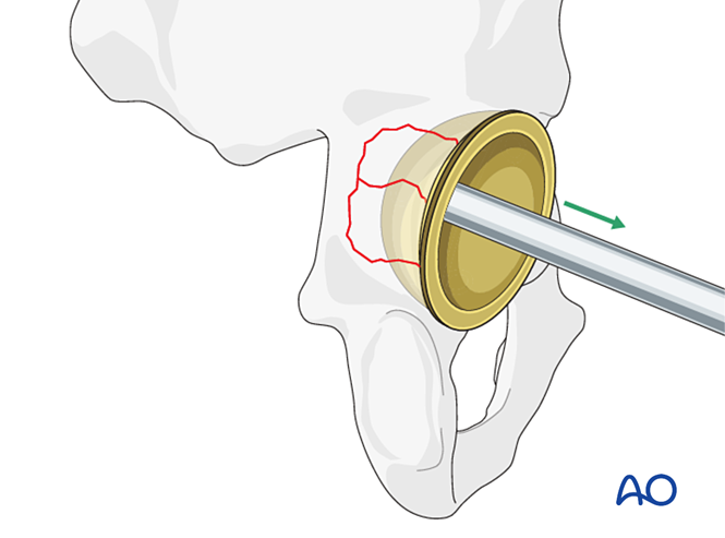 ORIF of posterior fractures with or without cup revision for ...