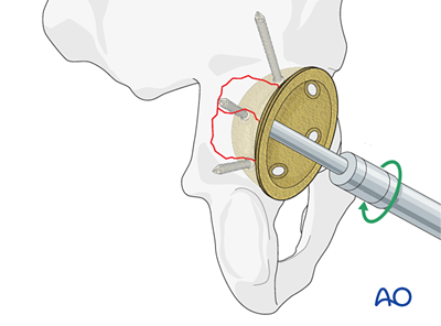 ORIF of posterior moiety fractures for Intraoperative fracture during ...