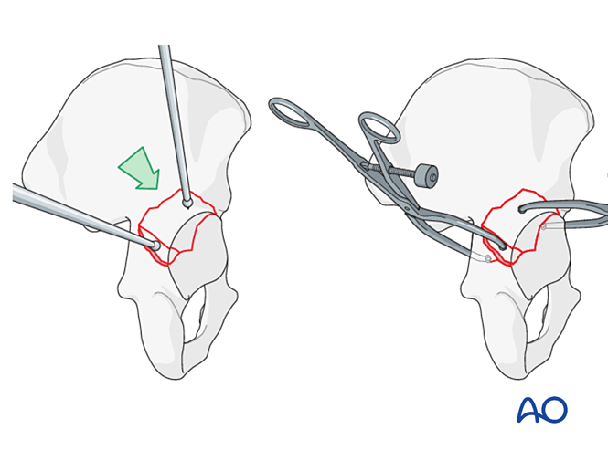ORIF (plate and screw) of posterior fractures with or without cup ...