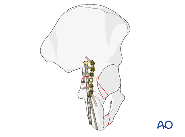 Orif Of Posterior Moiety Fractures For Intraoperative Fracture During