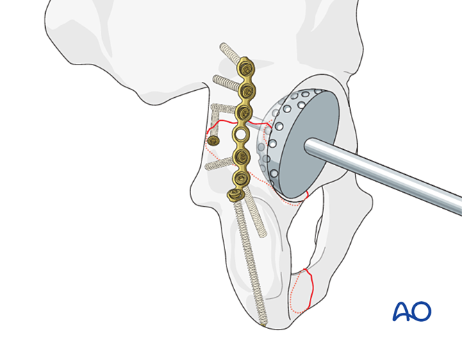 ORIF of posterior moiety fractures for Intraoperative fracture during ...