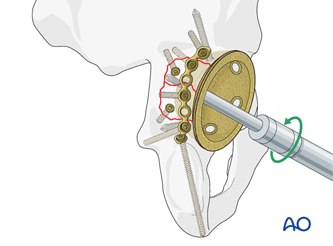 ORIF of posterior moiety fractures for Intraoperative fracture during ...