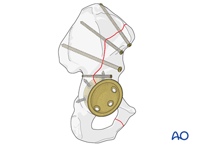 ORIF (plate and screw) of anterior fractures with or without cup ...