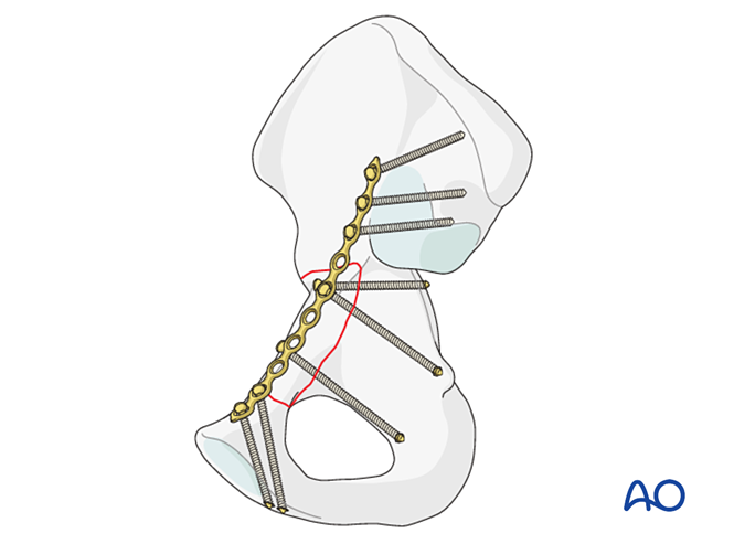 ORIF (plate and screw) of anterior fractures with or without cup ...