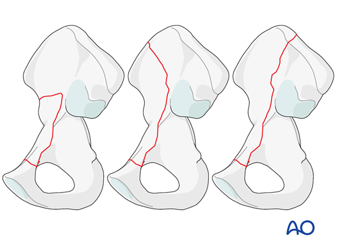 ORIF of anterior moiety fractures for Spontaneous acetabular fracture