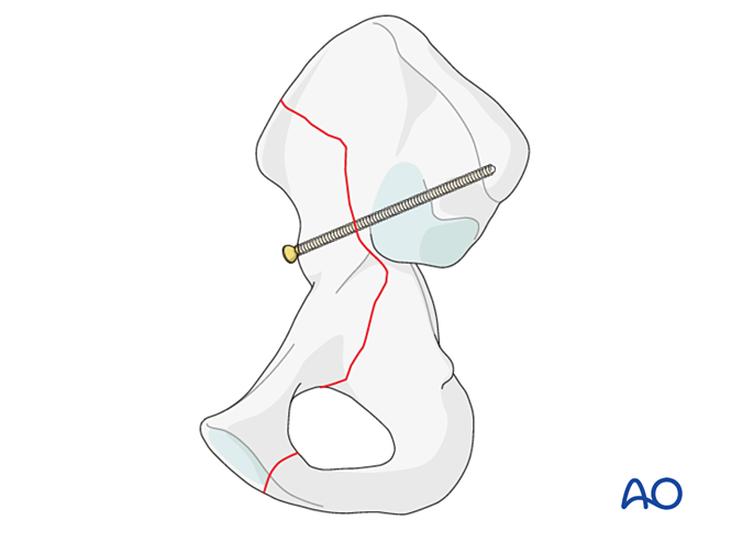 ORIF (plate and screw) of anterior fractures with or without cup ...