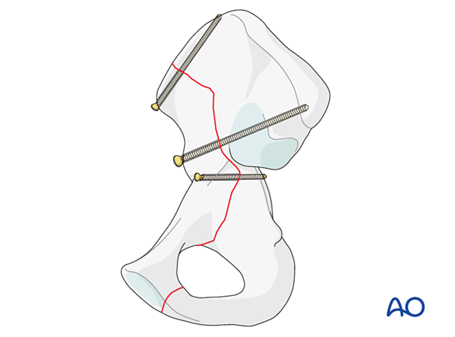 ORIF of anterior moiety fractures for Spontaneous acetabular fracture