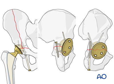 Posterior column screw fixation for Spontaneous acetabular fracture
