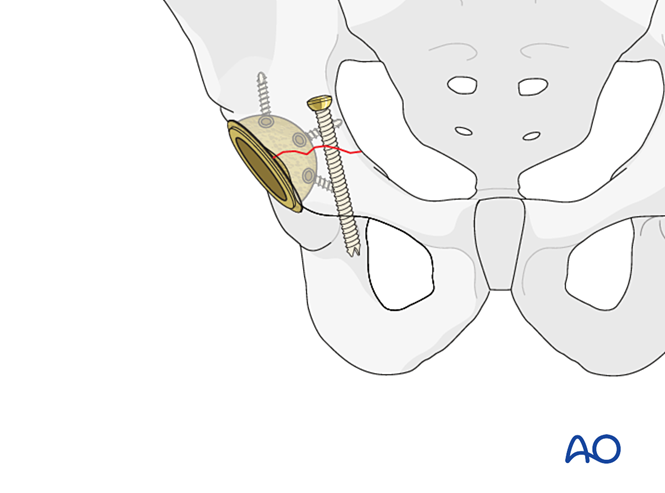 Posterior column screw fixation for Spontaneous acetabular fracture