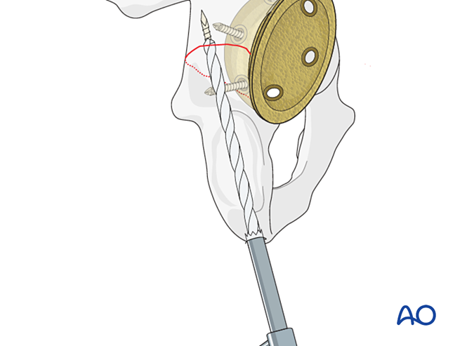 Posterior column screw fixation for Spontaneous acetabular fracture