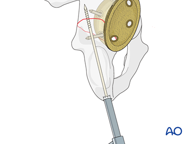 Posterior column screw fixation for Spontaneous acetabular fracture