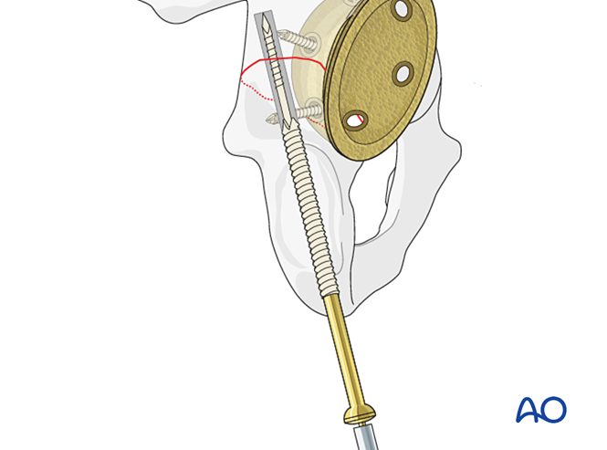 Posterior column screw fixation for Spontaneous acetabular fracture