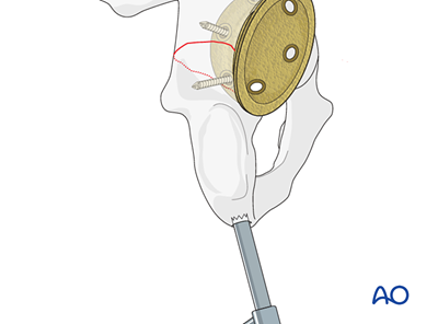 Posterior column screw fixation for Spontaneous acetabular fracture