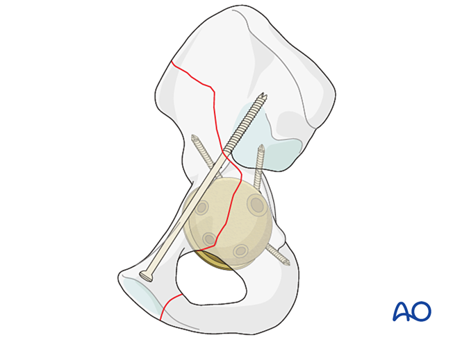 Anterior column screw fixation for Intraoperative acetabular fracture ...