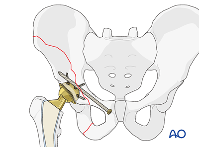 Anterior column screw fixation for Intraoperative acetabular fracture ...