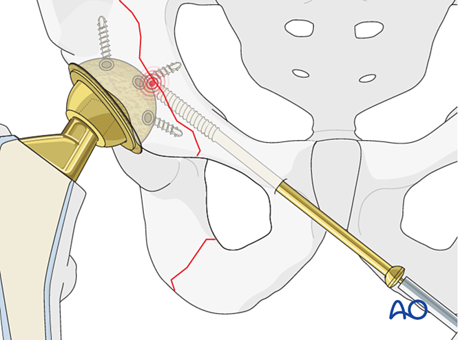 Anterior column screw fixation for Intraoperative acetabular fracture ...