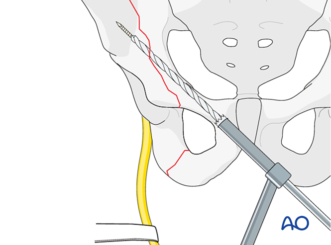 Anterior column screw fixation for Intraoperative acetabular fracture ...