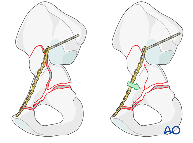 ORIF of protrusio fractures for Intraoperative acetabular fracture ...