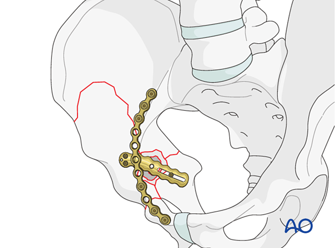 ORIF of protrusio fractures for Intraoperative acetabular fracture ...