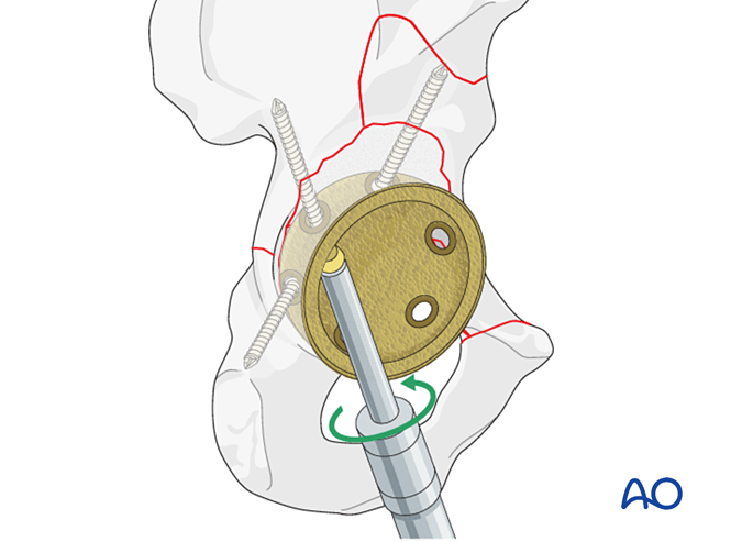 ORIF of protrusio fractures for Spontaneous acetabular fracture