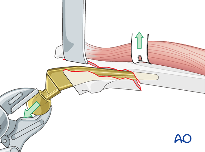 Resection arthroplasty for Fracture around the stem with an unstable ...