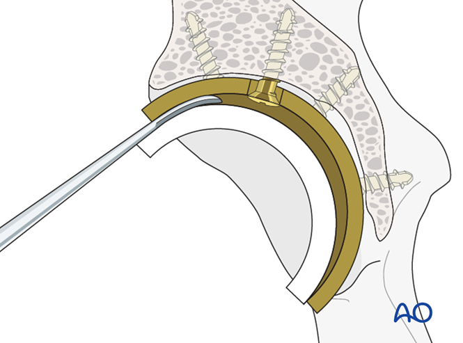 Resection arthroplasty for Pelvic discontinuity