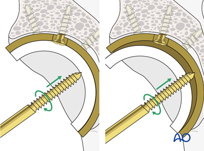 Acetabular cup removal