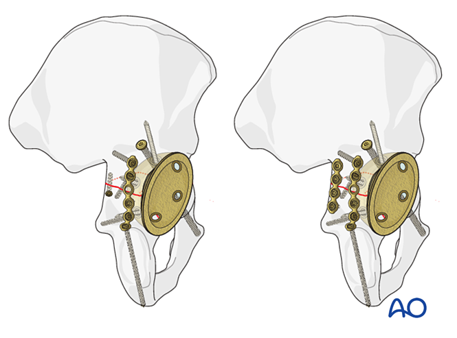 ORIF of transverse fractures for Spontaneous acetabular fracture