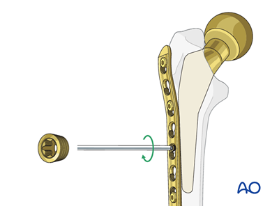 Adjunct plate options