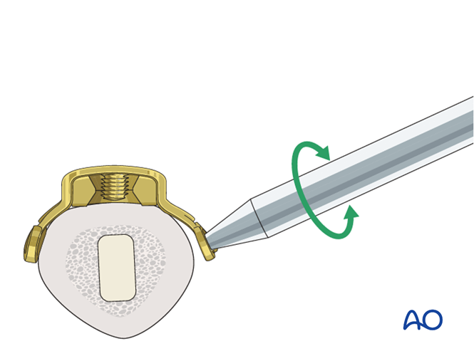 Adjunct plate options
