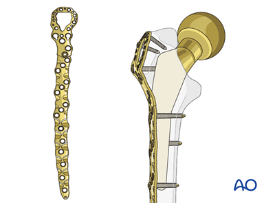 Adjunct plate options