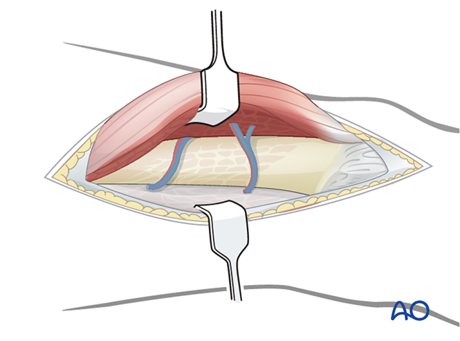 Lateral/anterolateral approach to the distal femur
