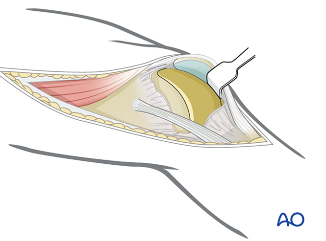 Lateral/anterolateral approach to the distal femur
