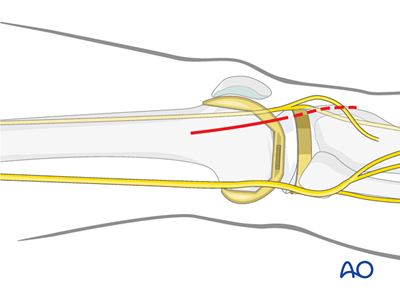 MIO approach to the distal femur from lateral/anterolateral