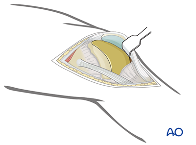 MIO approach to the distal femur from lateral/anterolateral