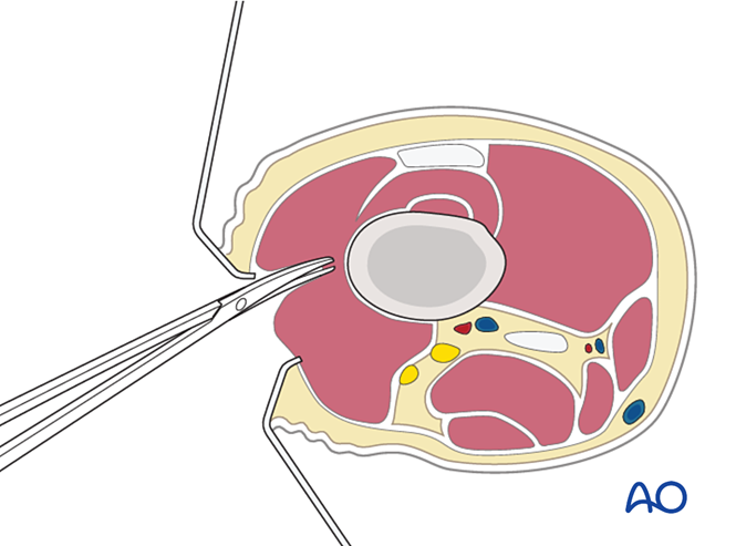 MIO approach to the distal femur from lateral/anterolateral