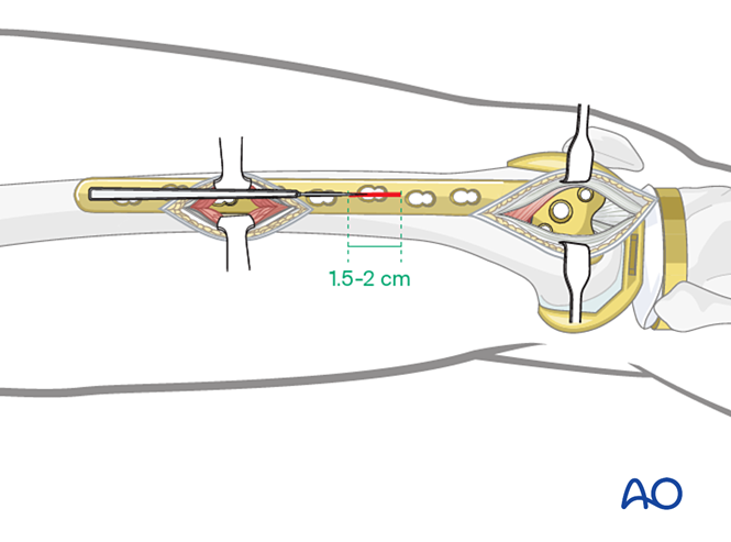 MIO approach to the distal femur from lateral/anterolateral