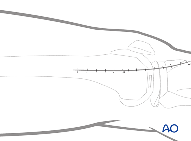 MIO approach to the distal femur from lateral/anterolateral