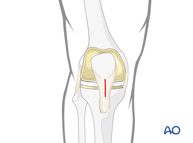 Retrograde nailing approach to the distal femur