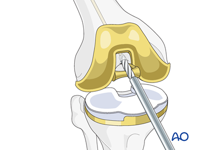 Retrograde nailing approach to the distal femur