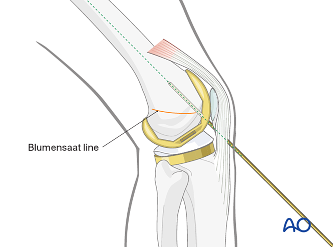 Retrograde nailing approach to the distal femur