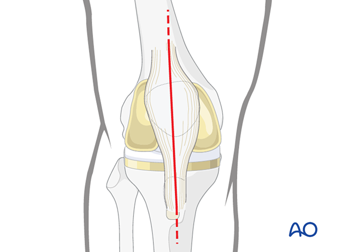 Proximal tibia replacement for Fracture around a loose tibial component ...