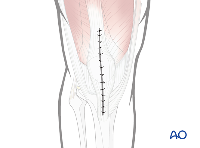 Midline longitudinal approach