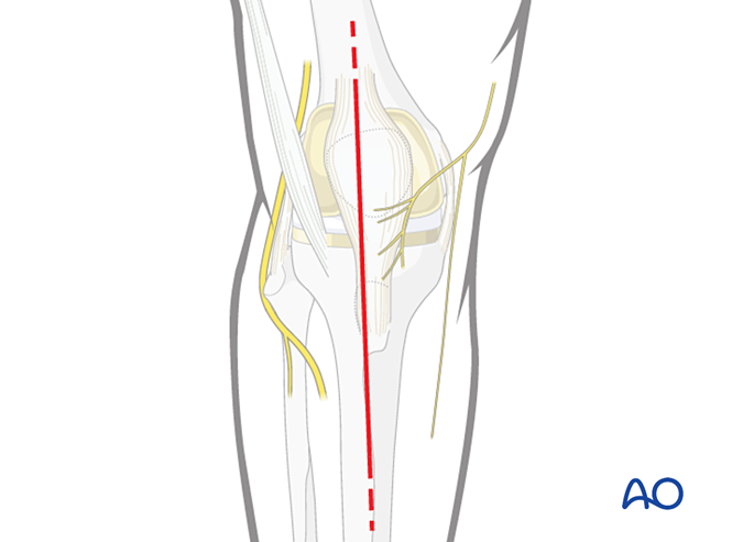 Anterolateral approach to the proximal tibia