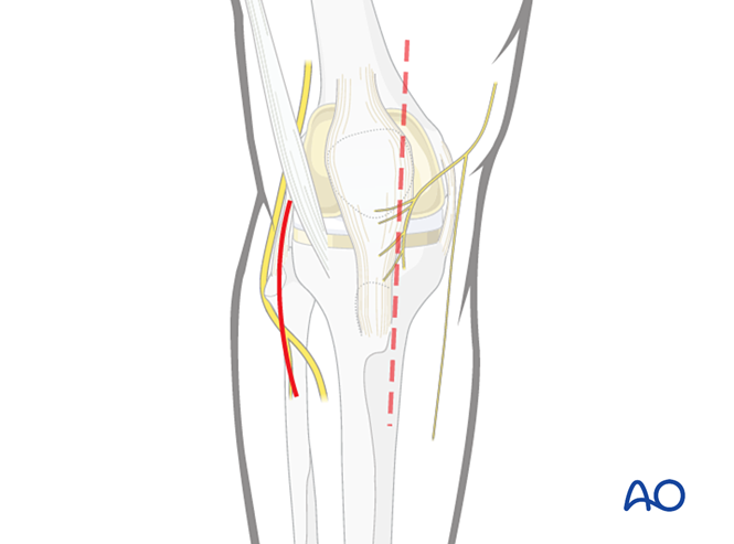 Anterolateral approach to the proximal tibia